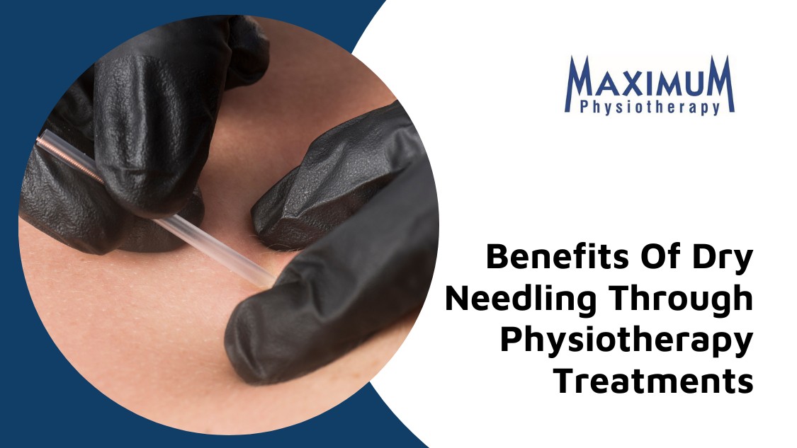 Seven Health Benefits of Dry Needling in Collingwood